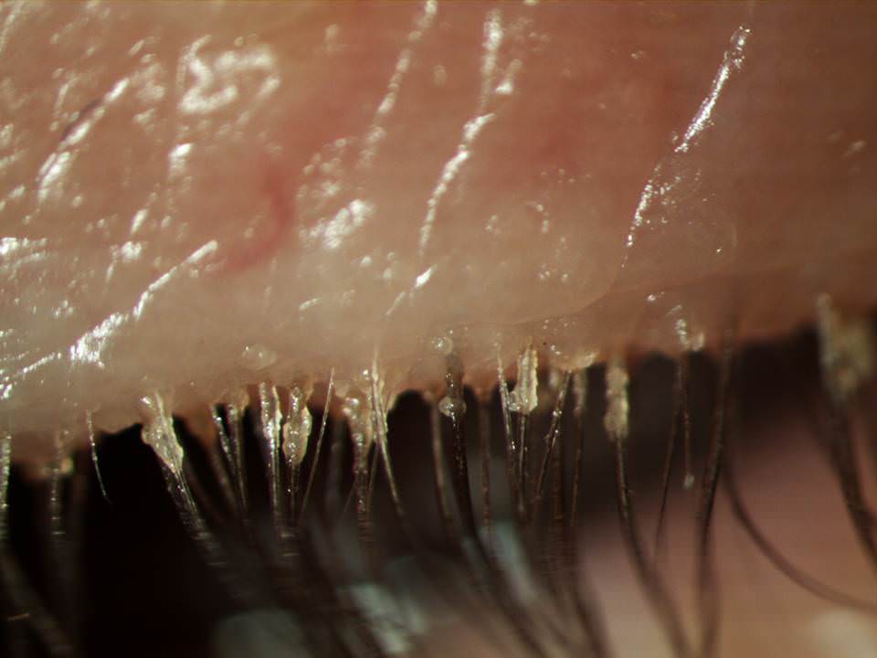 Blepharitis - Dry Eye Doctor