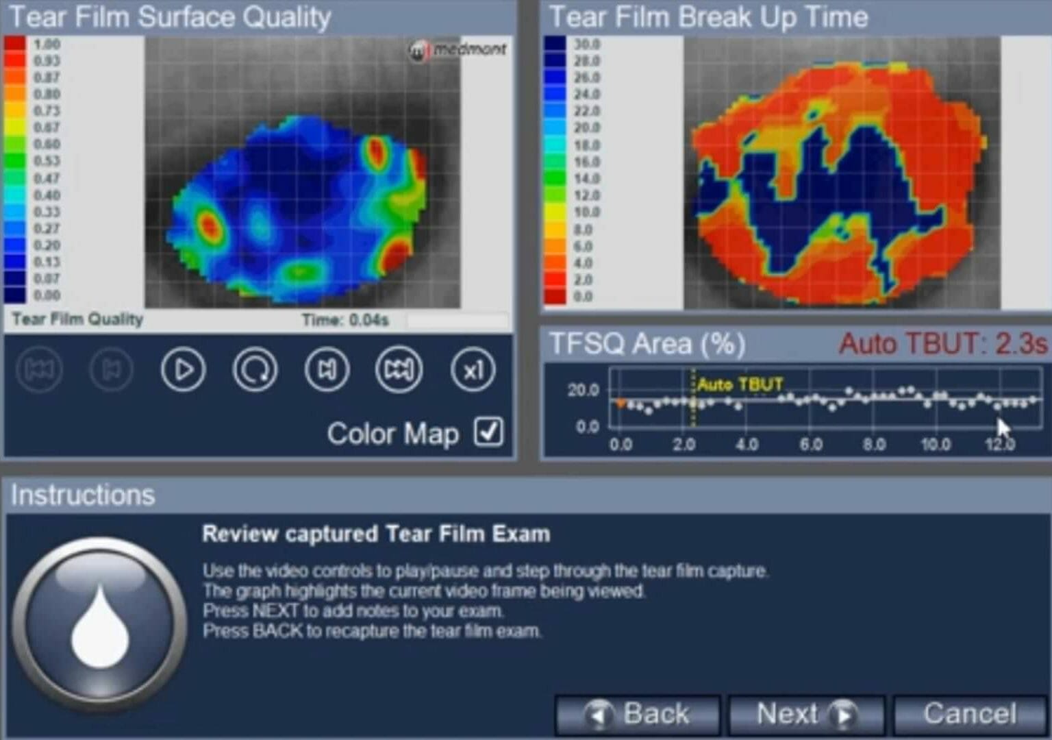 Is there a Better way to Assess Tear Stability? - Dry Eye Doctor